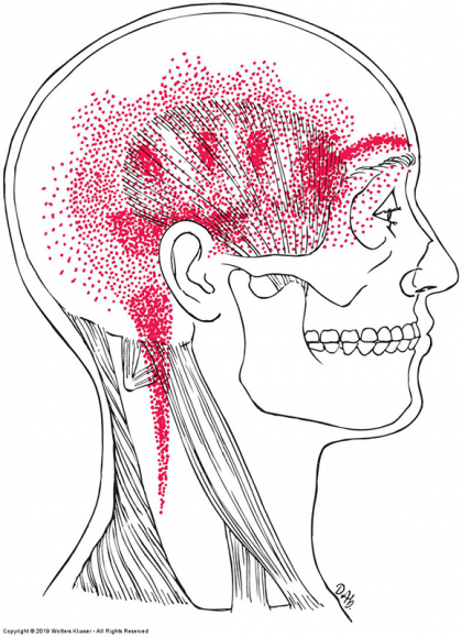 Neuromuscular Therapy and Headache Management for the Most Prevalent ...
