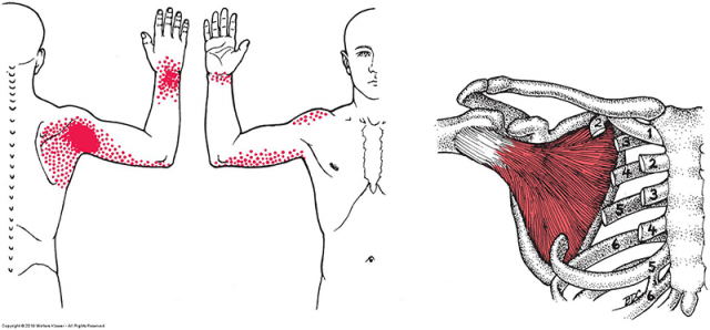 What You Need to Know About Frozen Shoulder and Neuromuscular Therapy ...